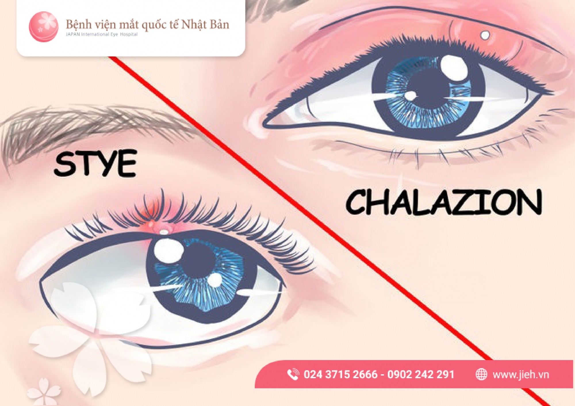LẸo ChẮp NhỮng ĐiỀu CẦn BiẾt